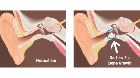 A Guide To Surfer’s Ear And How To Prevent It - Surf Indonesia